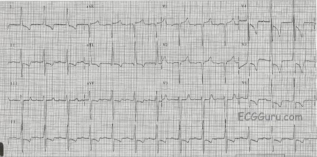 Left ventricular hypertrophy | ECG Guru - Instructor Resources Left ventricular hypertrophy | ECG Guru - Instructor Resources
